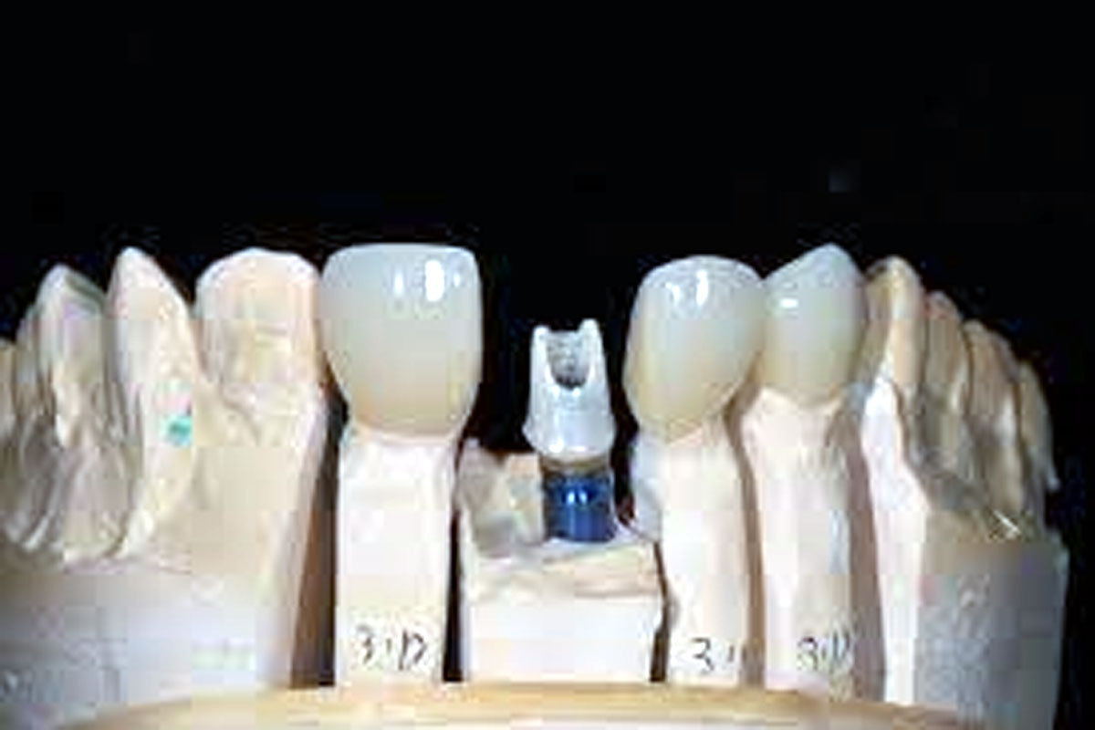 Services Ali Dental Lab