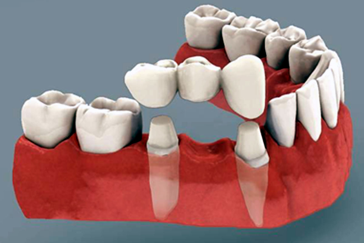 Services – Ali Dental Lab